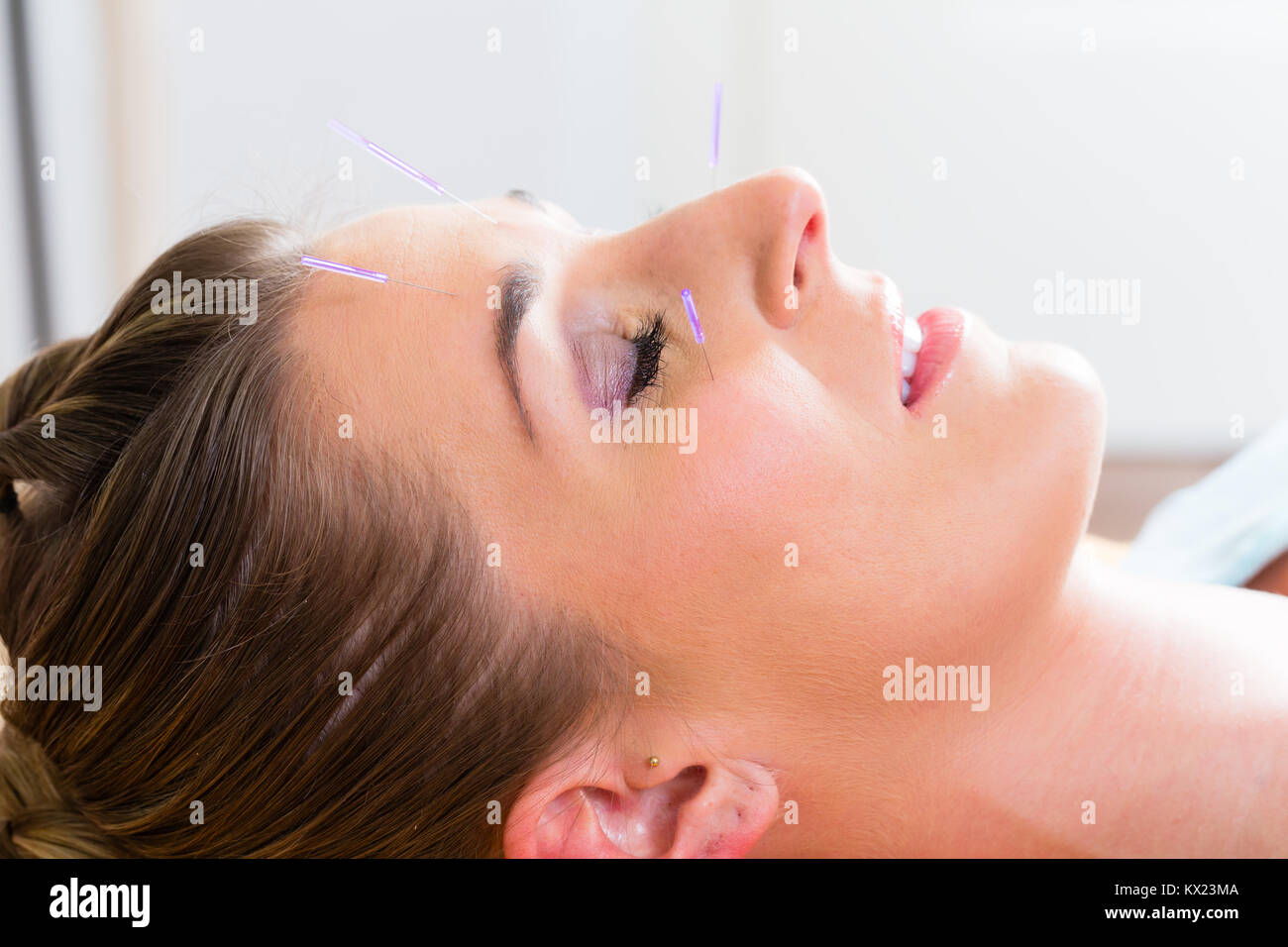 Woman at acupuncture with needles in face Stock Photo - Alamy