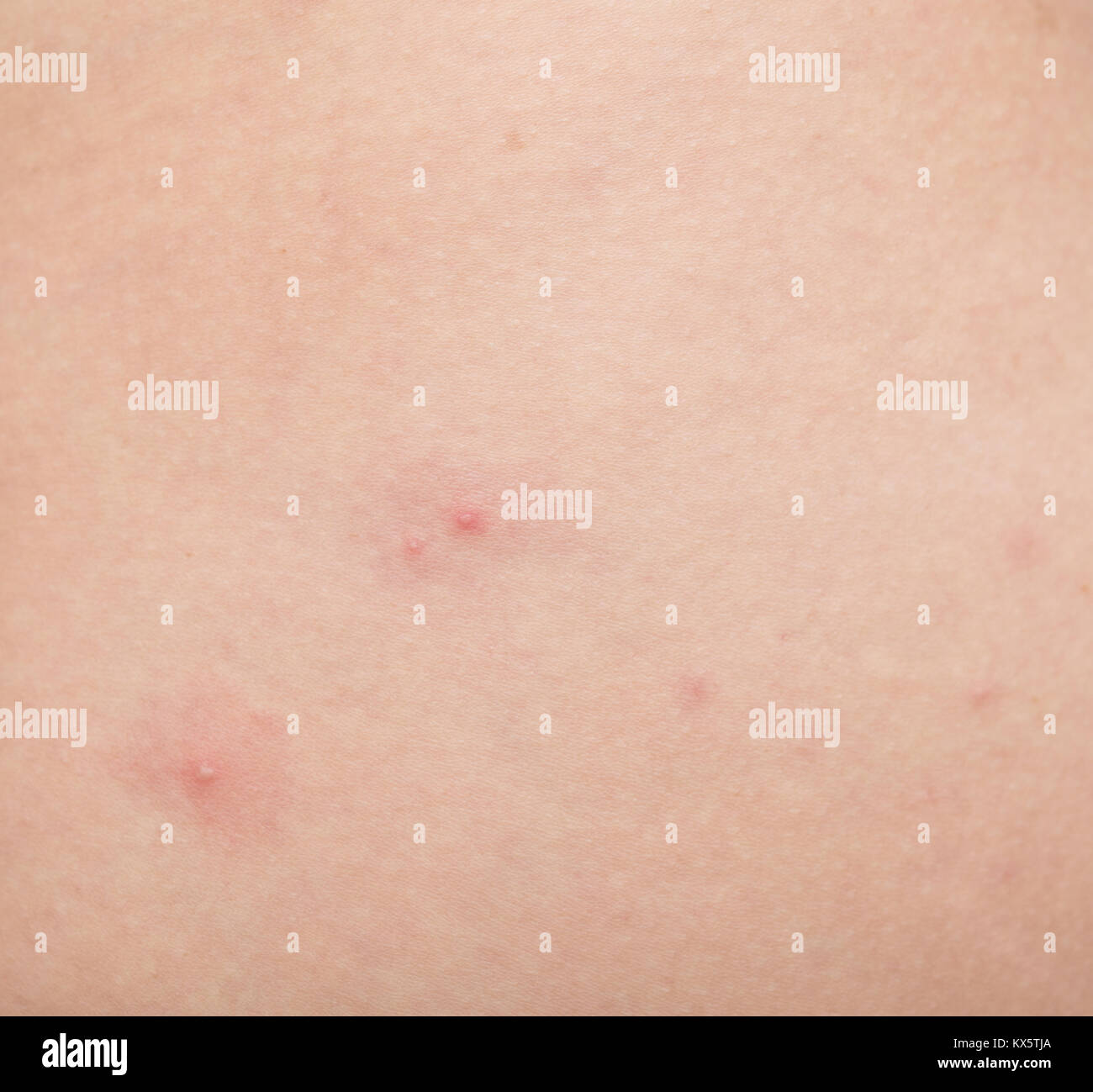 Human skin with red pimples Stock Photo - Alamy