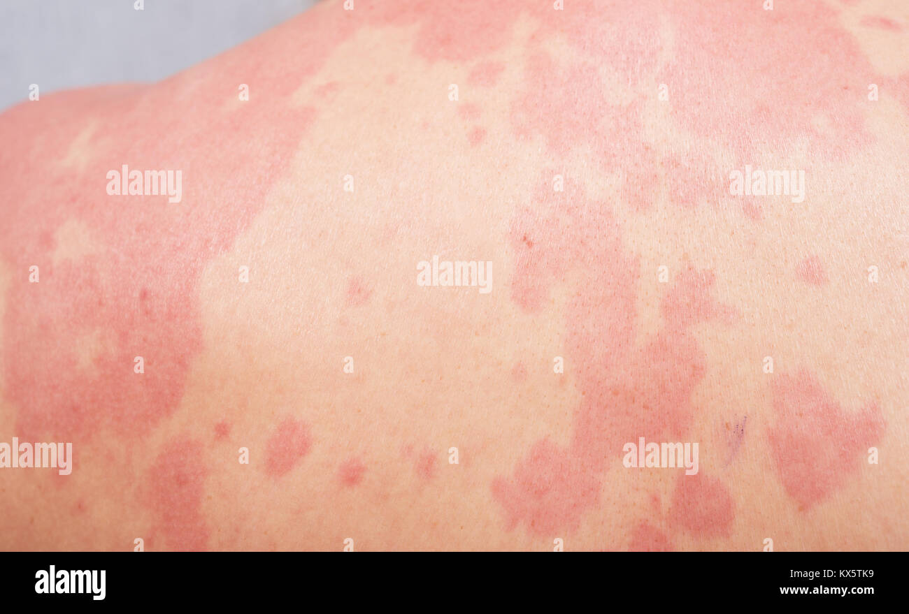 Allergy on a woman skin Stock Photo - Alamy