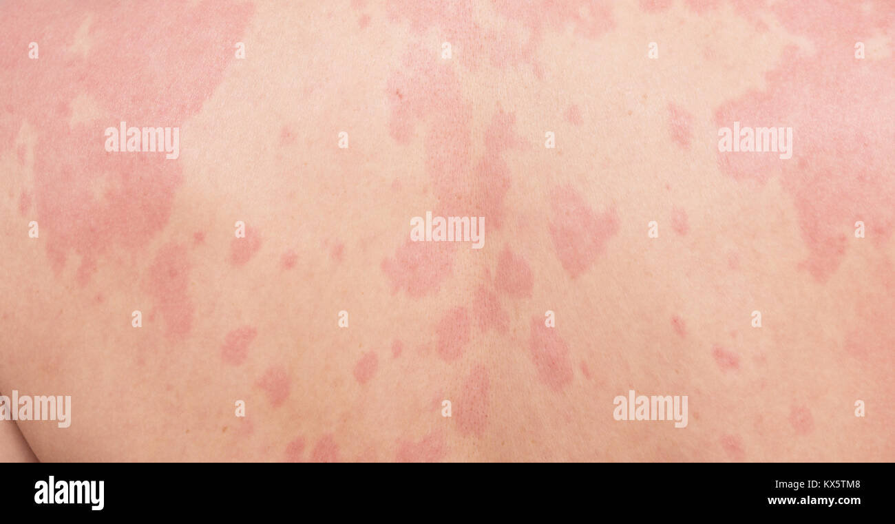 Allergy on a human skin Stock Photo - Alamy