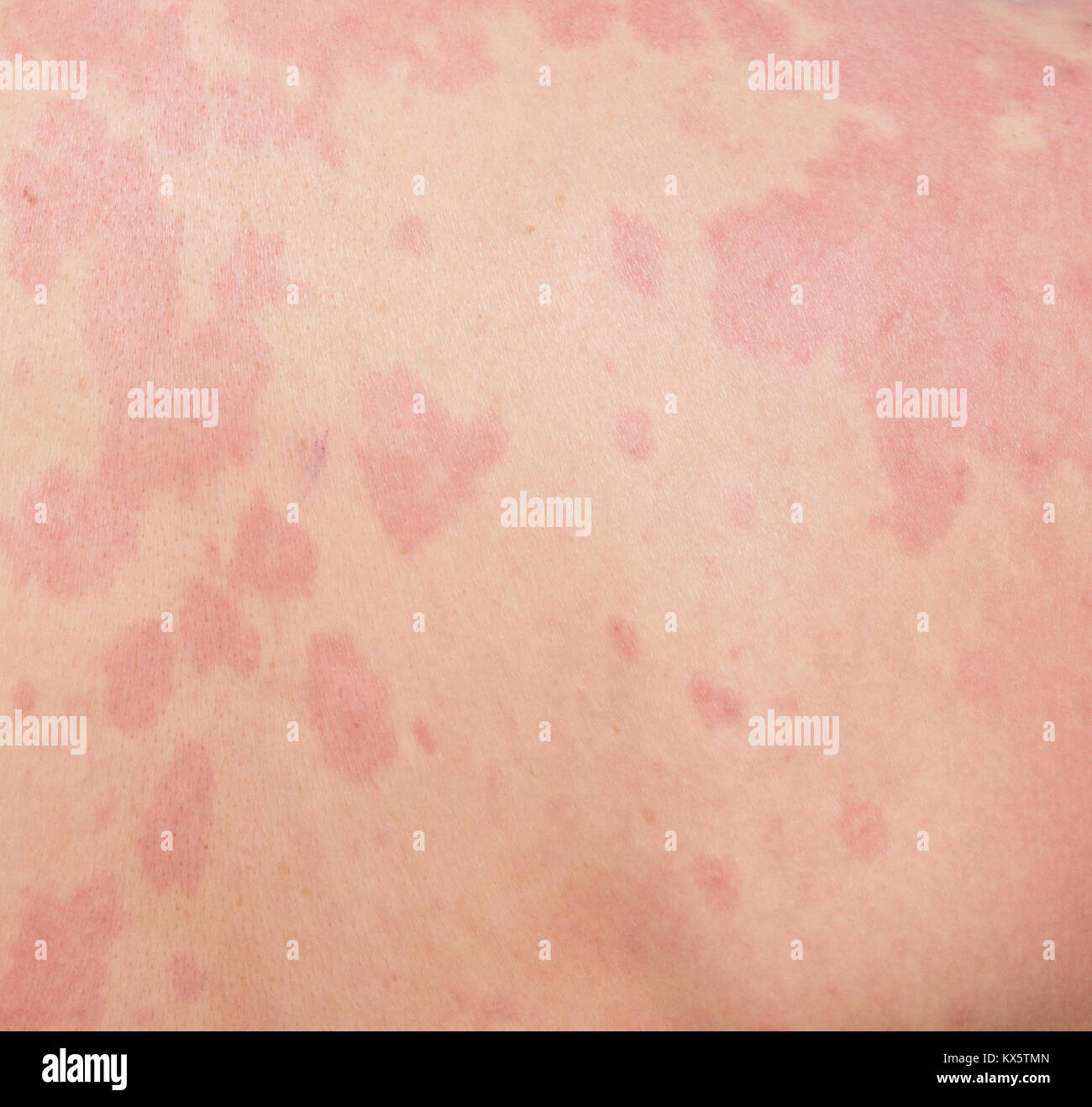 Allergy on a human skin Stock Photo - Alamy