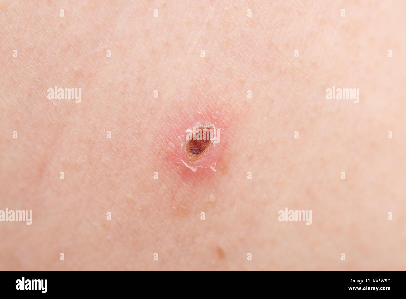 Close up shot of problematic human skin Stock Photo - Alamy