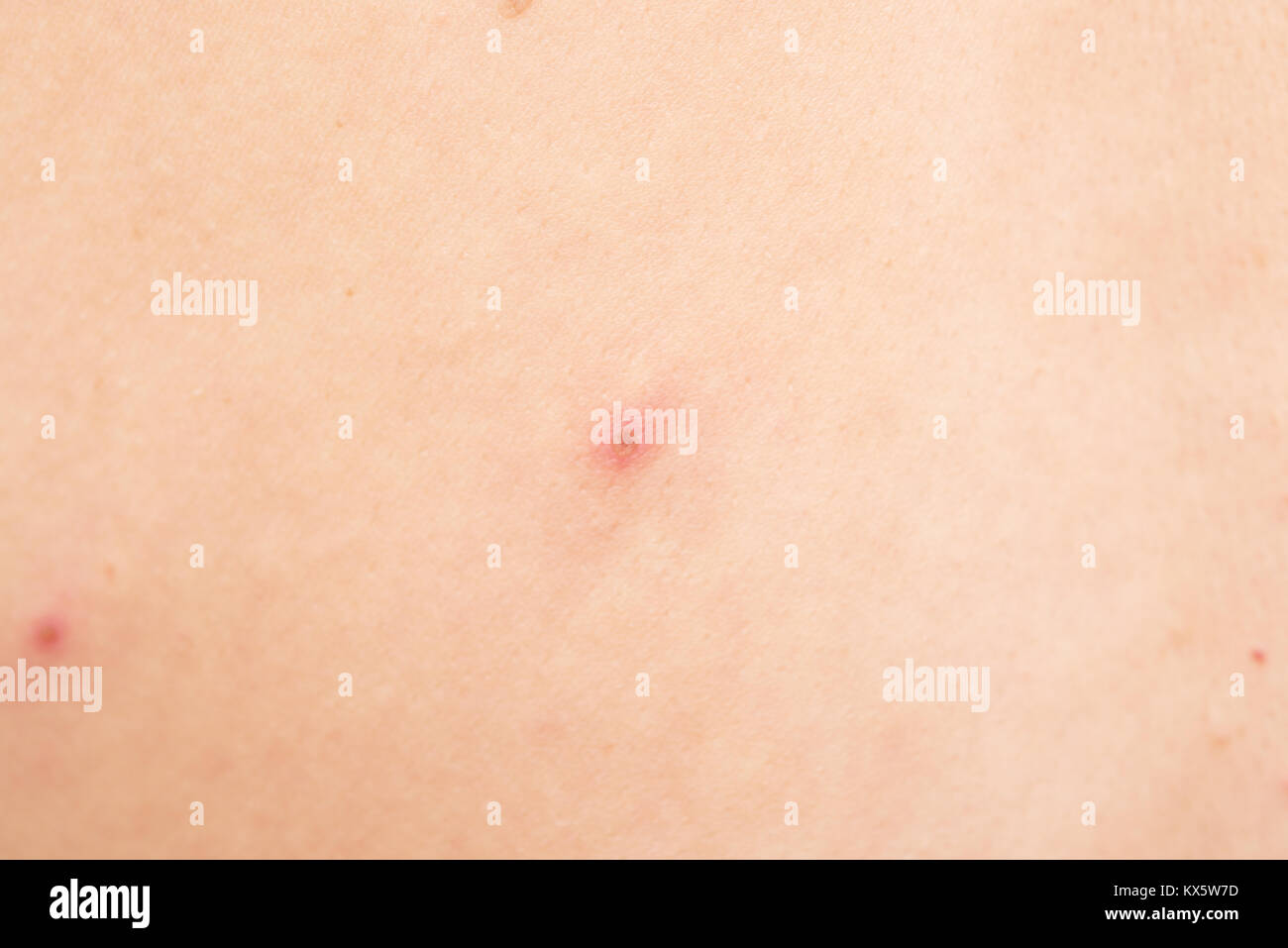 Problematic skin hi-res stock photography and images - Alamy