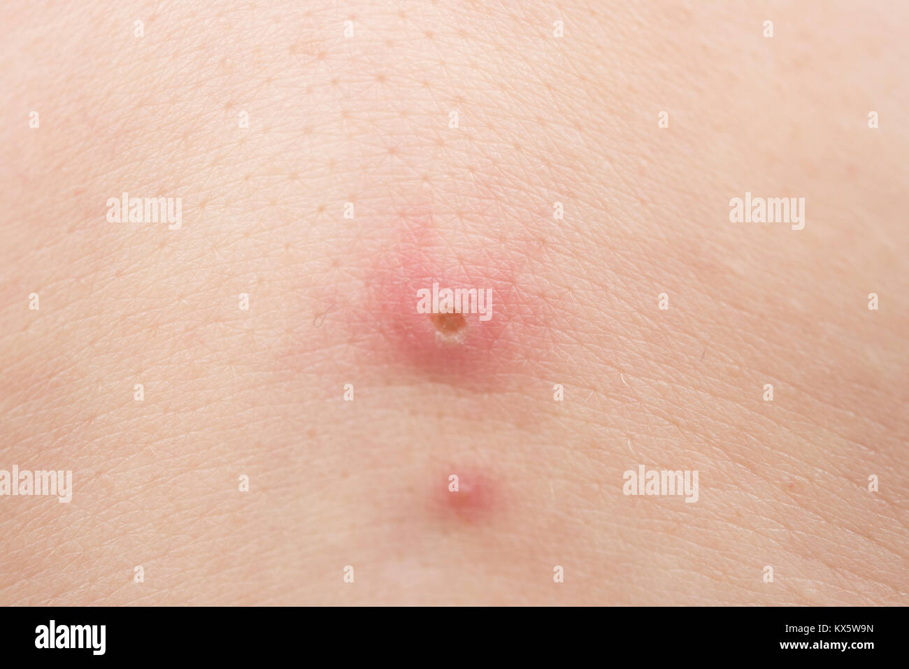 Close up shot of acne on skin Stock Photo - Alamy