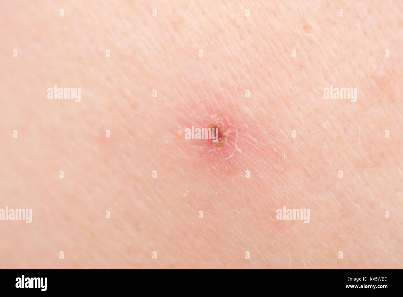 Close up shot of problematic human skin Stock Photo - Alamy