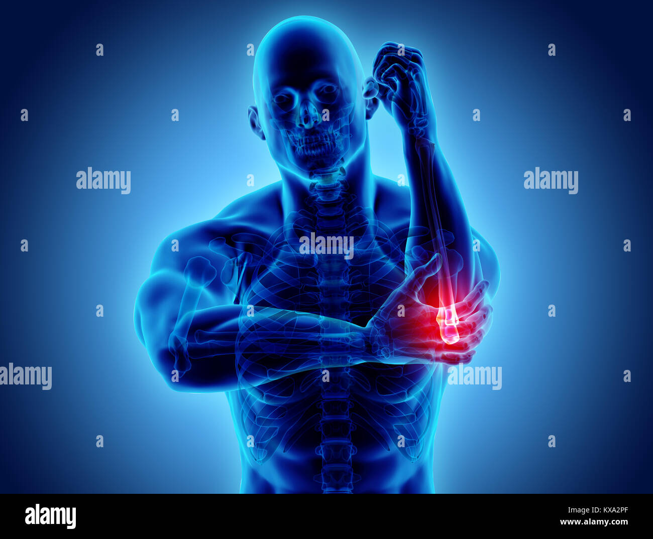 3d illustration of human elbow injury, medical concept Stock Photo - Alamy