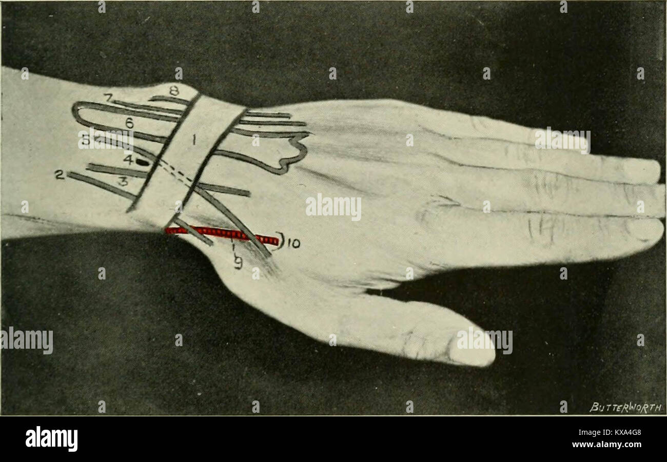 "Landmarks and surface markings of the human body" (1913 Stock Photo ...