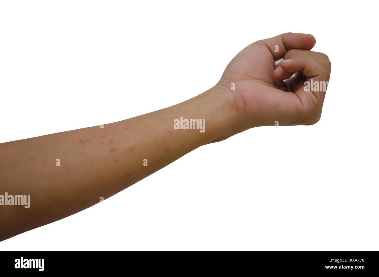 Rash in the arm on the white background Stock Photo - Alamy