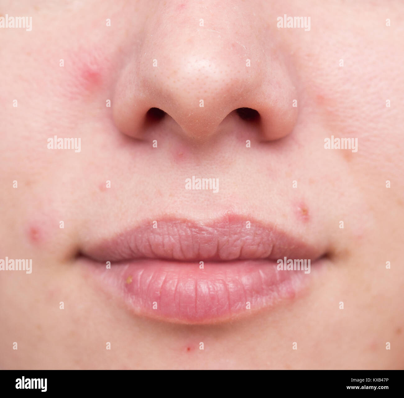 Woman face with problematic skin Stock Photo - Alamy