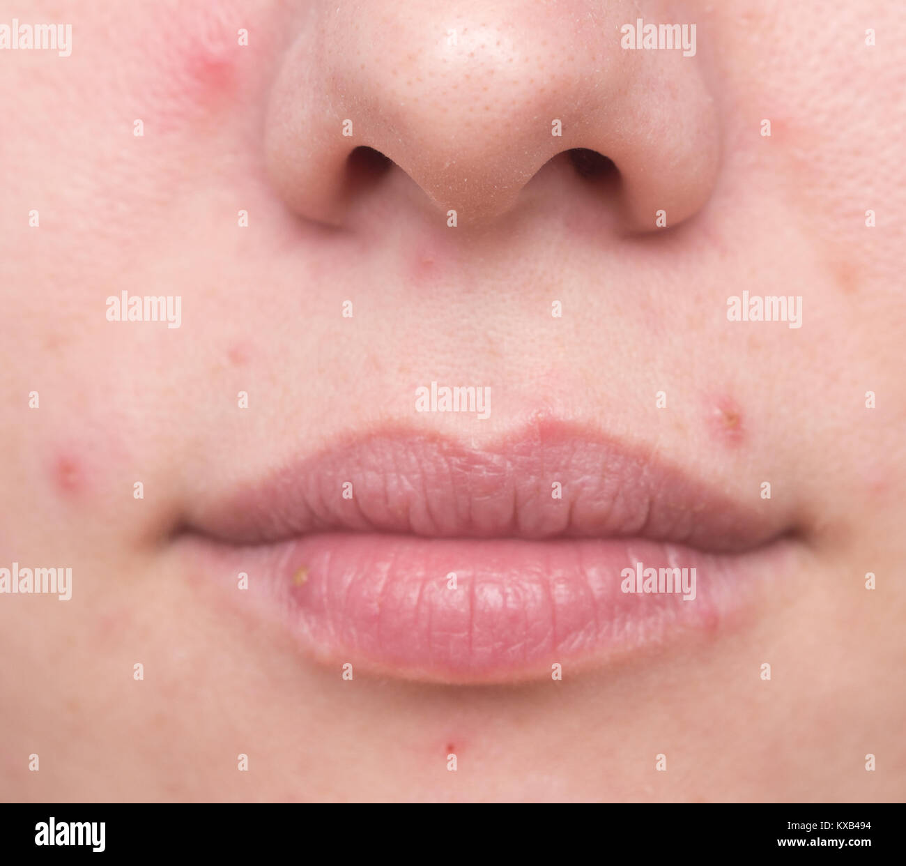 Woman face with problematic skin Stock Photo - Alamy