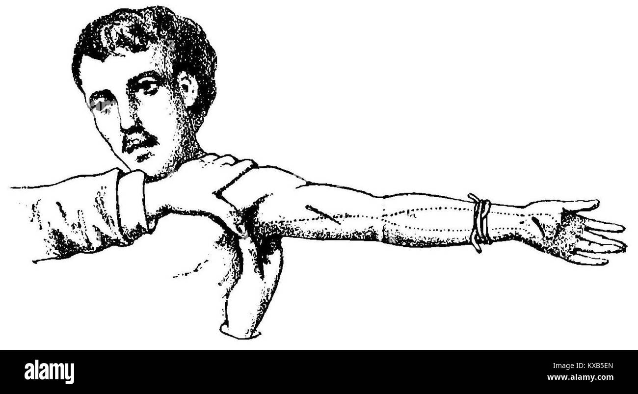 This refers to a medical image demonstrating axillary compression, part ...