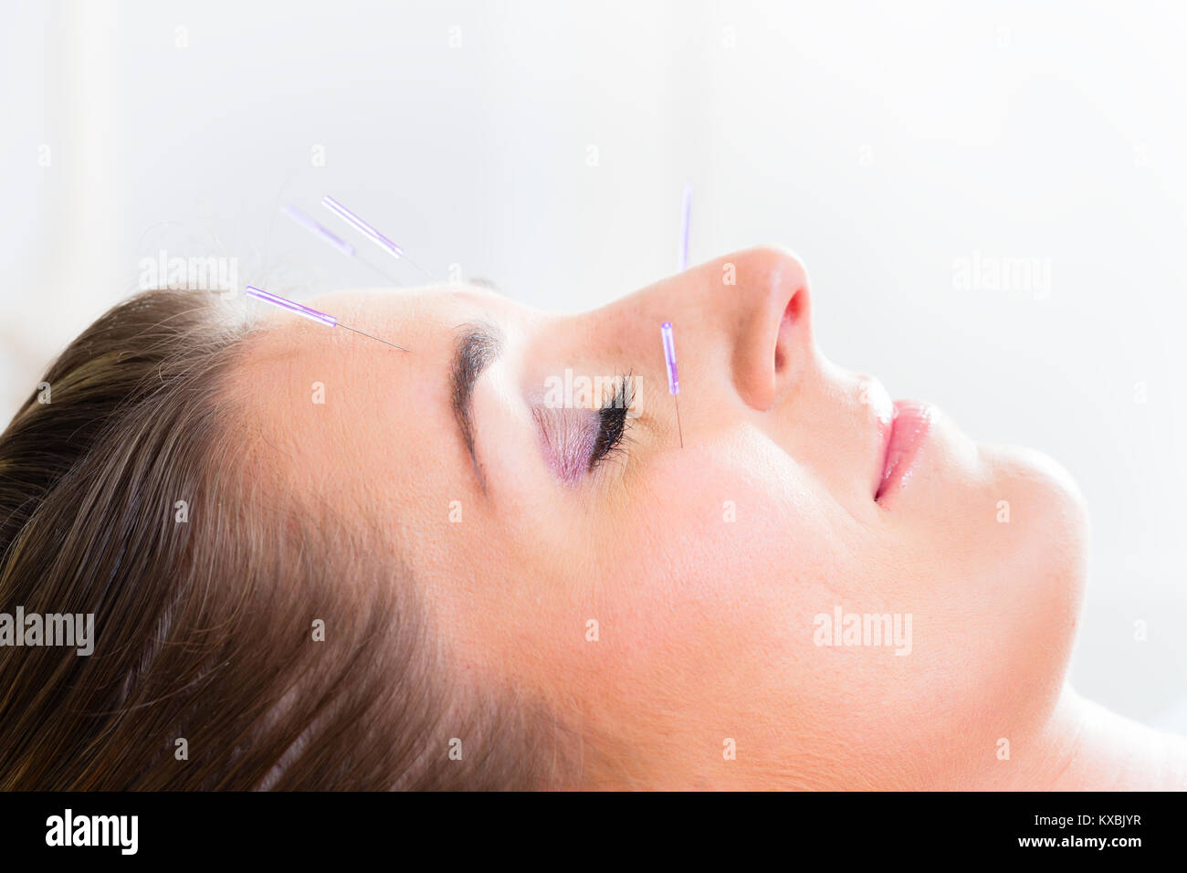 Girl acupuncture hi-res stock photography and images - Alamy