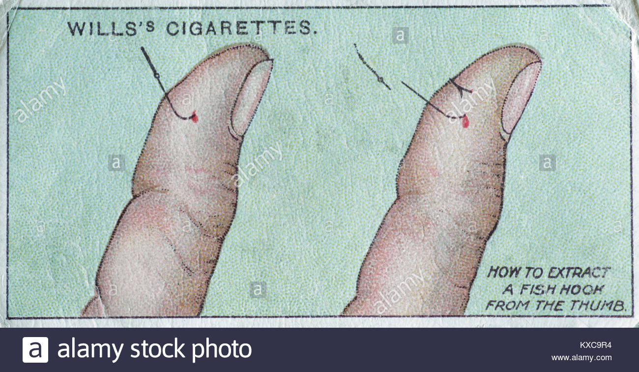 Vintage First Aid illustrations - How to extract a fish hook from the ...