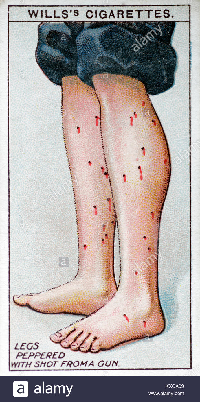 Gunshot wound leg hi-res stock photography and images - Alamy