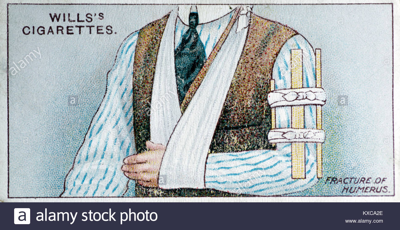 Vintage First Aid illustrations - Fracture of the humerus Stock Photo ...