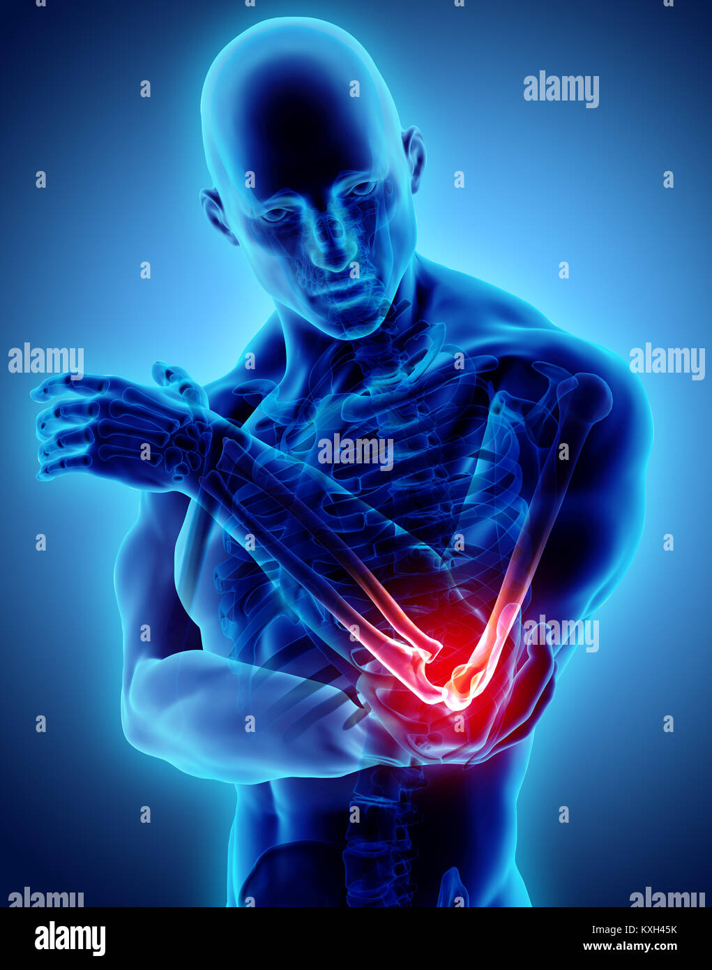 3d illustration of human elbow injury, medical concept Stock Photo - Alamy