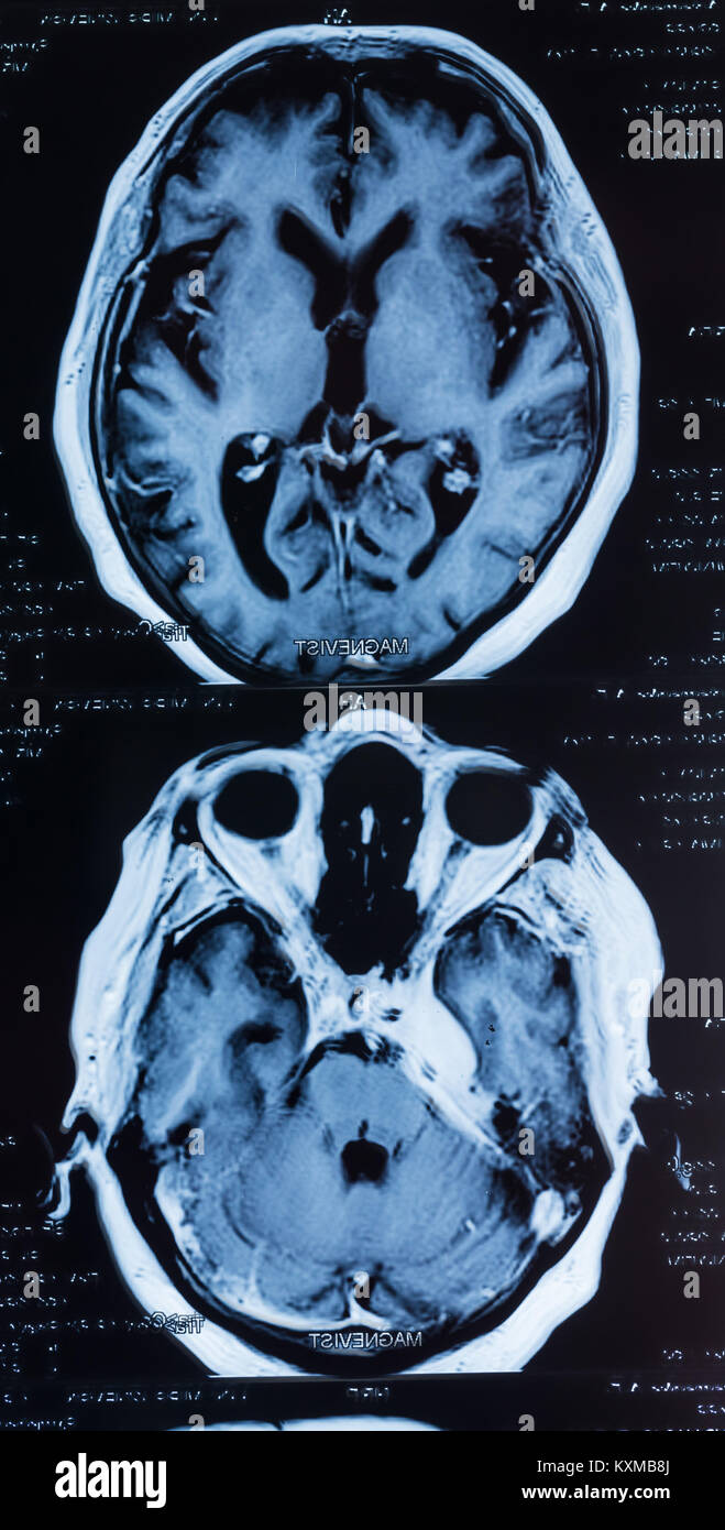 Head MRT. MR image of human brain Stock Photo - Alamy