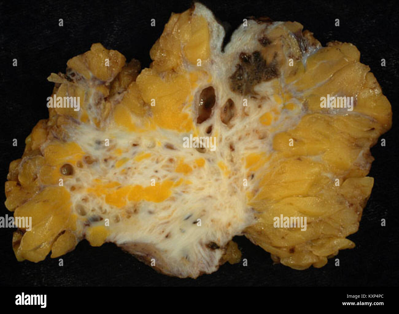 The image depicts endometriosis located in the abdominal wall ...