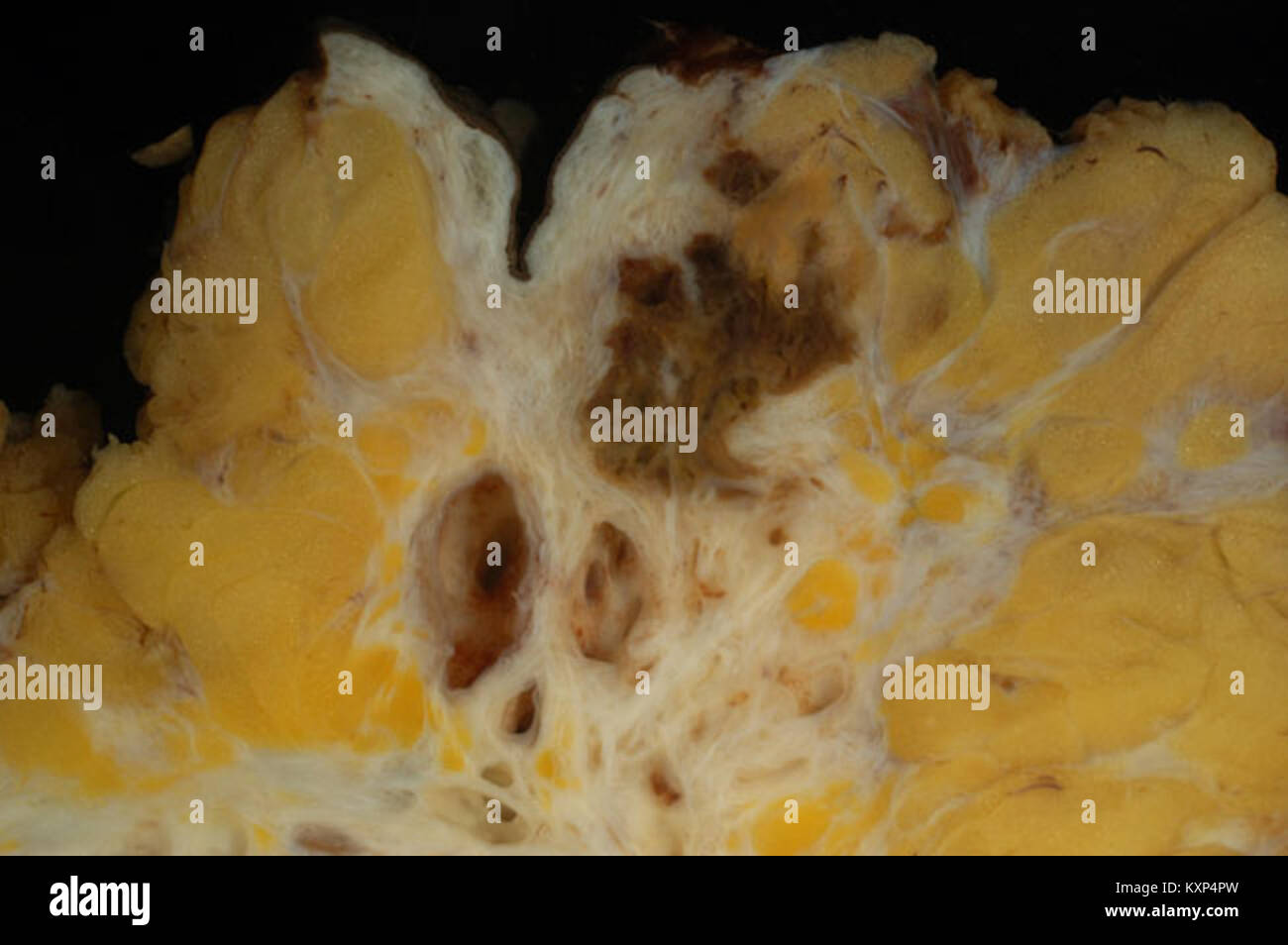 Endometriosis, abdominal wall 2 Stock Photo - Alamy