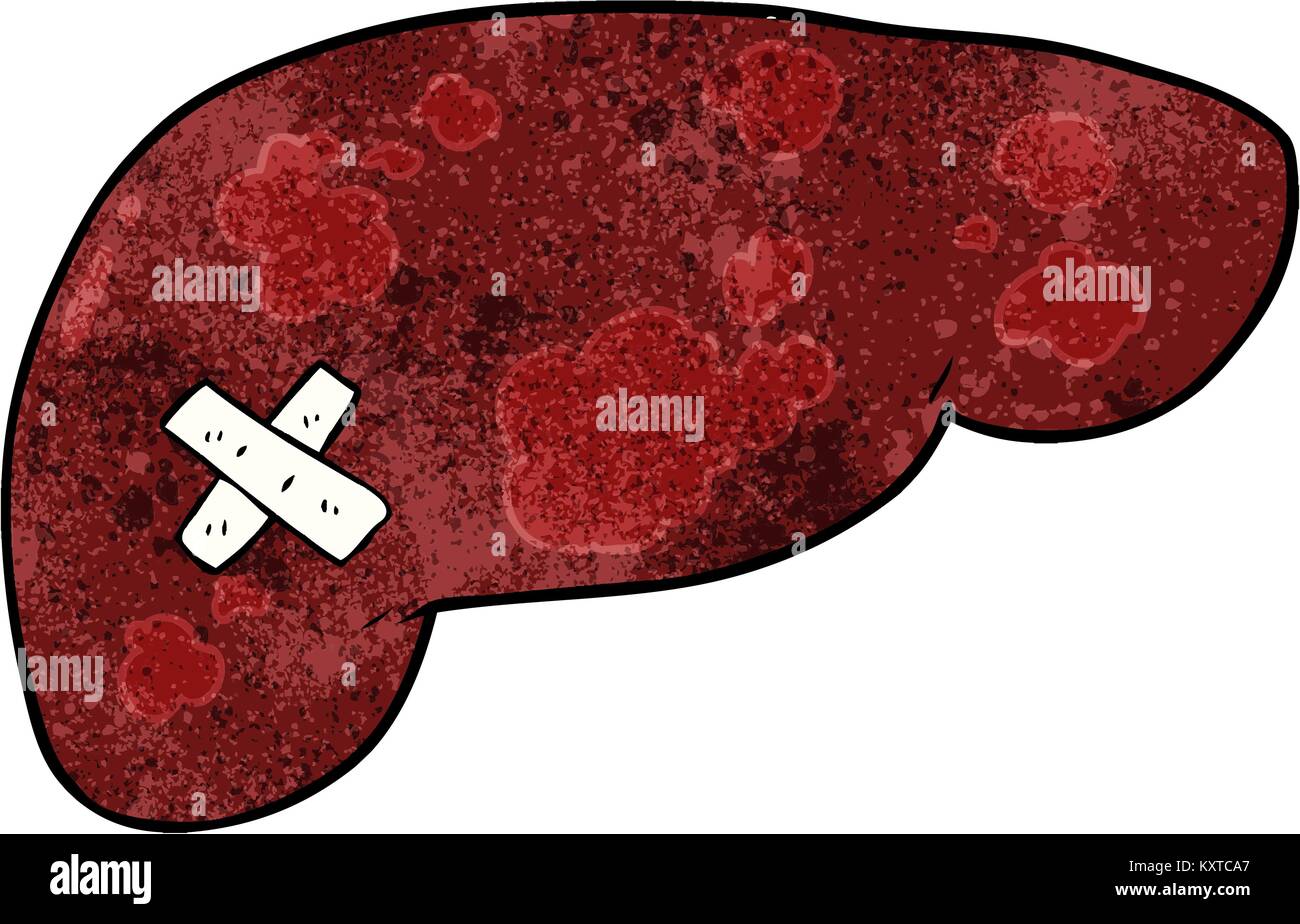 cartoon unhealthy liver Stock Vector Image & Art - Alamy