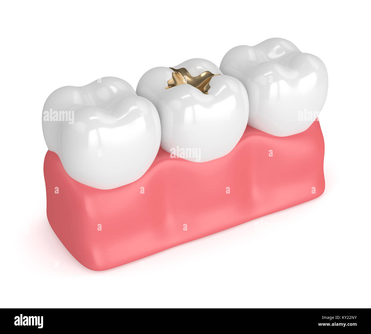 Gold teeth denture hi-res stock photography and images - Alamy