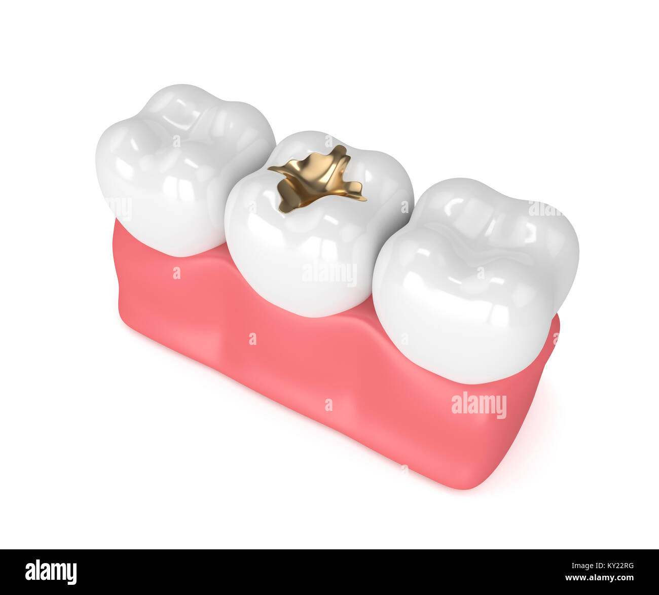 Gold teeth denture hi-res stock photography and images - Alamy