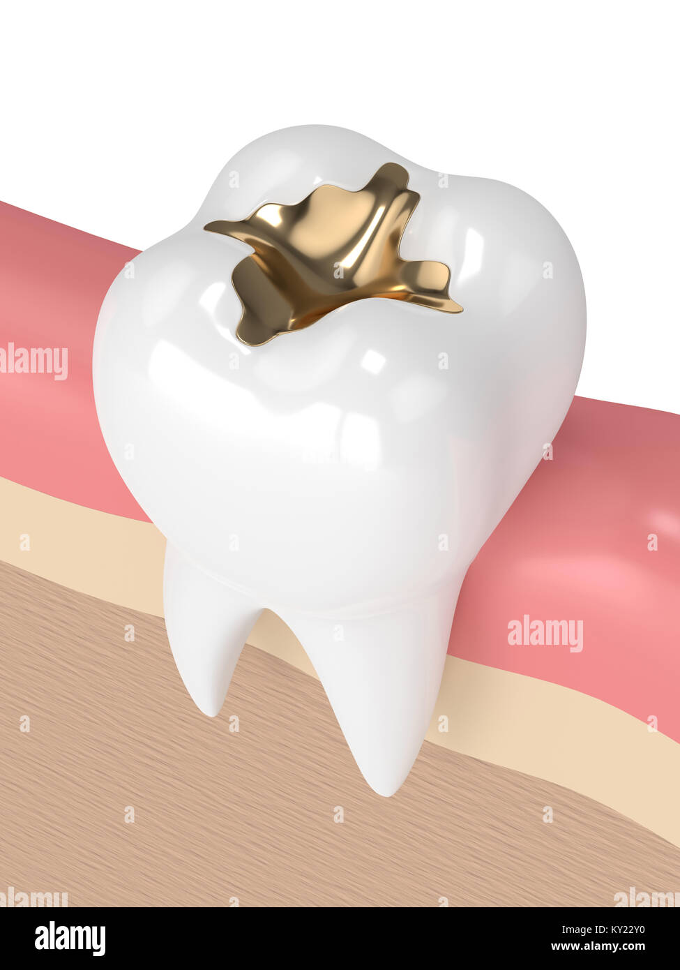 Gold tooth filling hi-res stock photography and images - Alamy