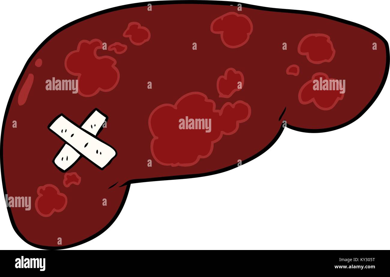 cartoon unhealthy liver Stock Vector Image & Art - Alamy