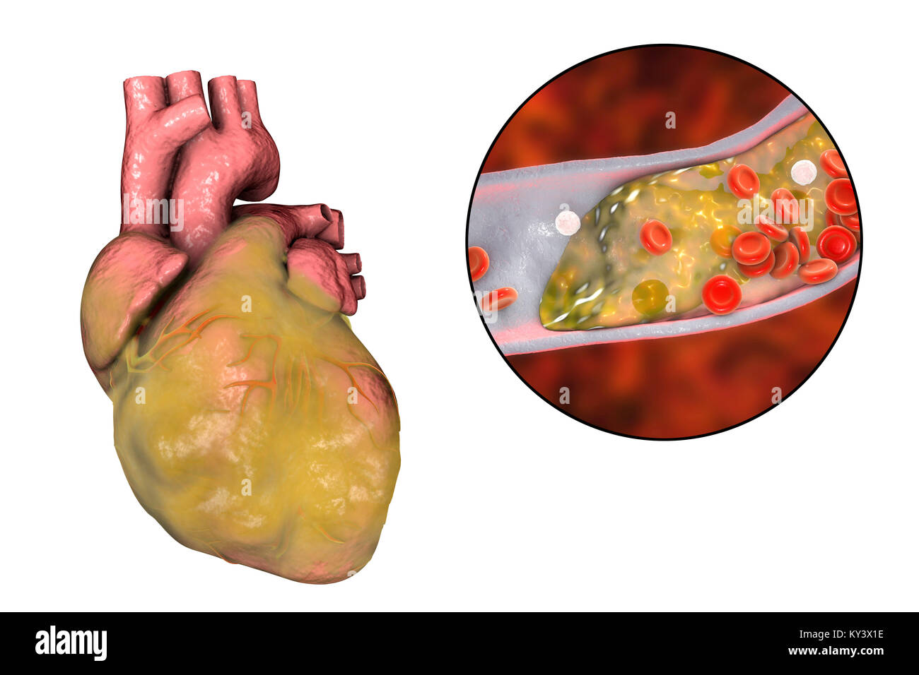 Computer illustration of a fatty heart and a coronary artery narrowed ...