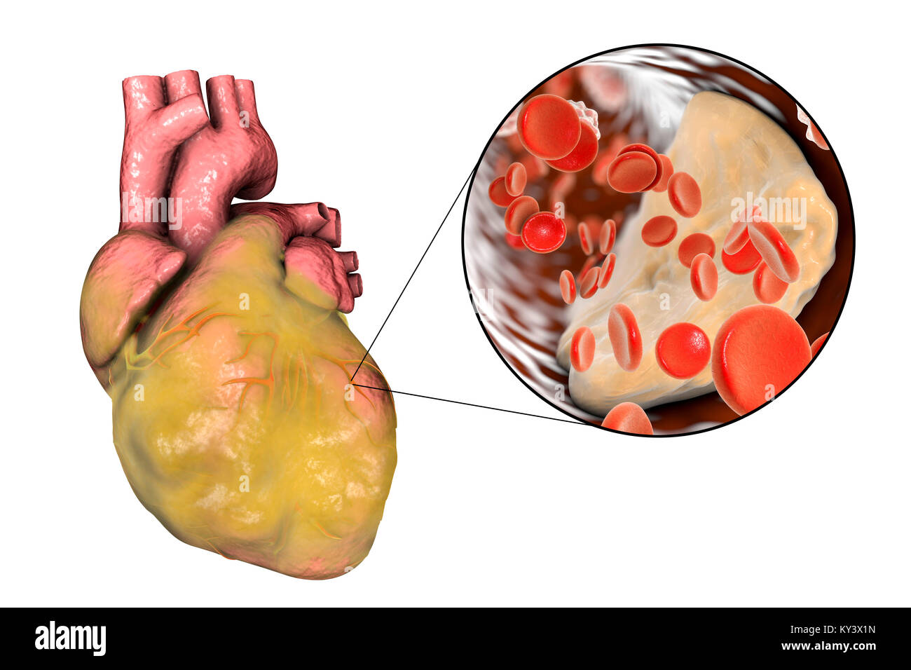 Coronary artery plaque hi-res stock photography and images - Alamy