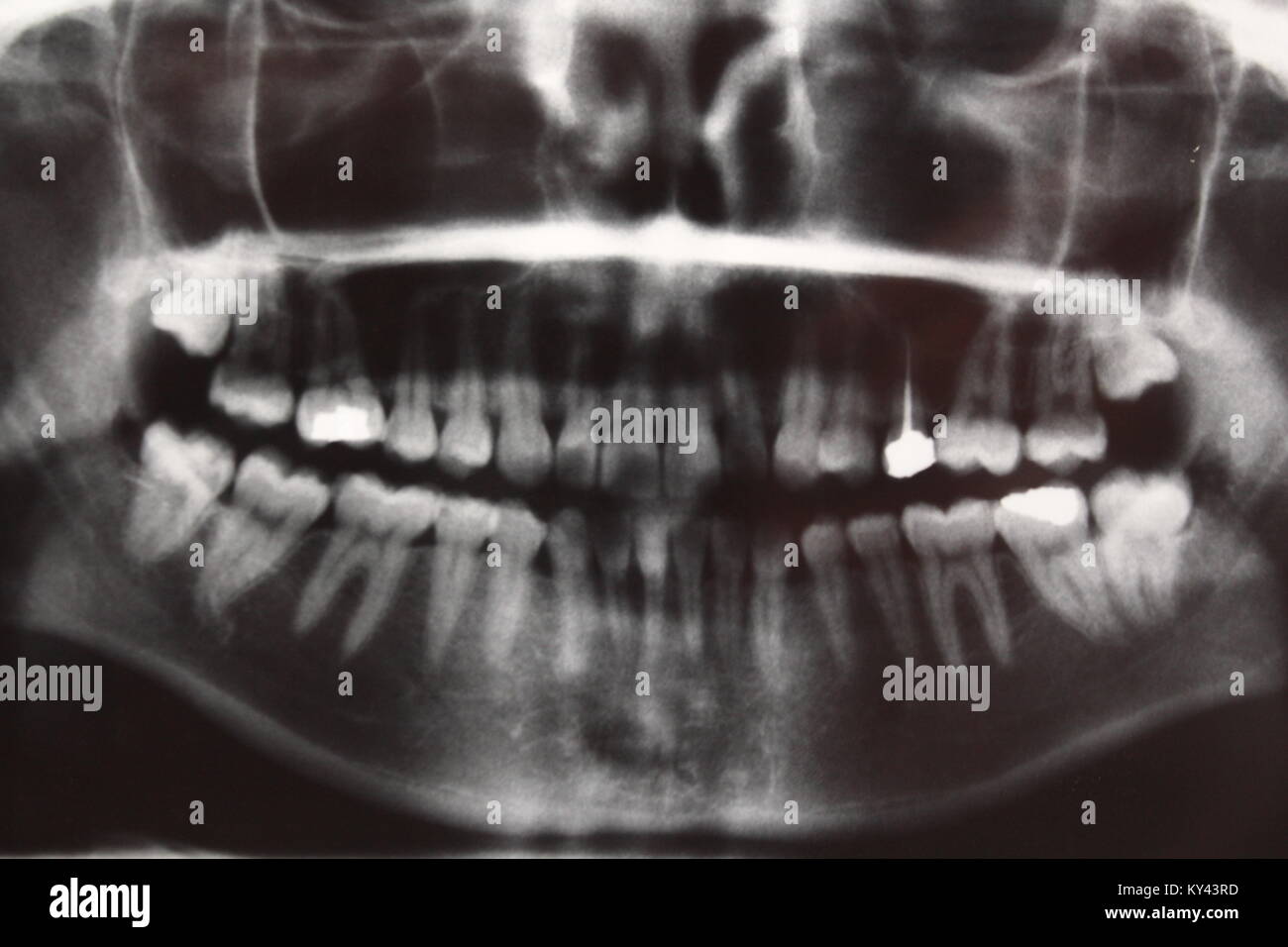 Dental panoramic x ray hi-res stock photography and images - Alamy