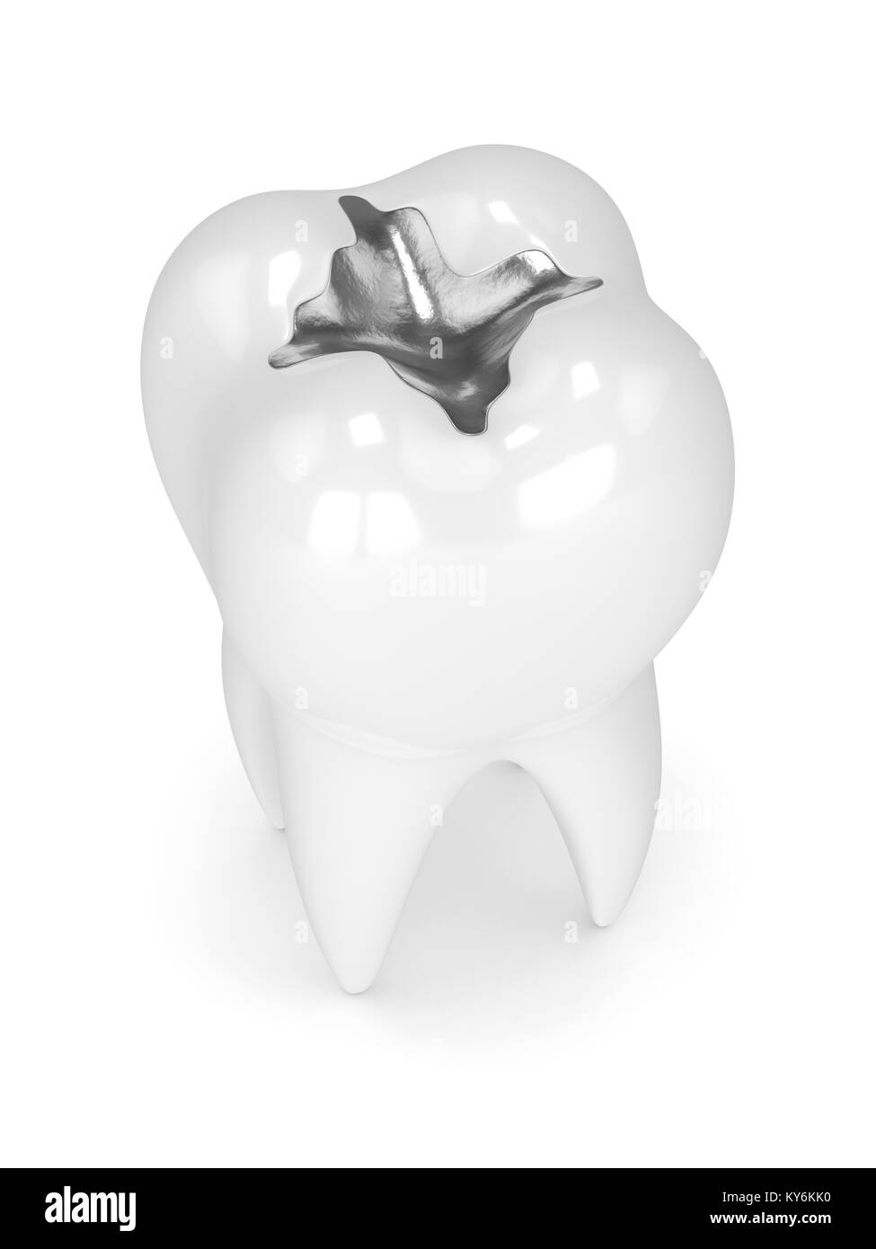 3d render of tooth with dental amalgam filling over white background ...