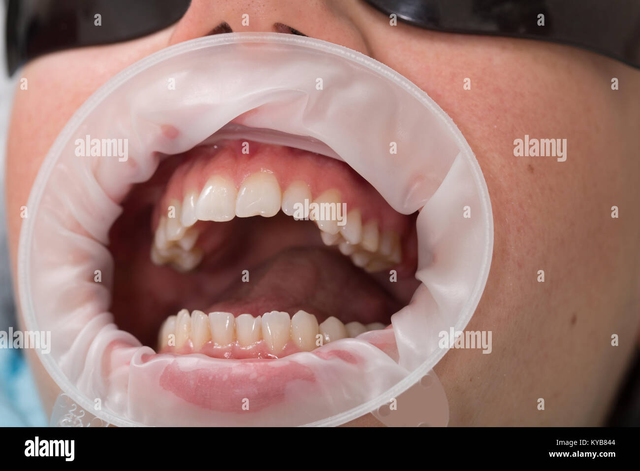 Human mouth open wide teeth hi-res stock photography and images - Alamy