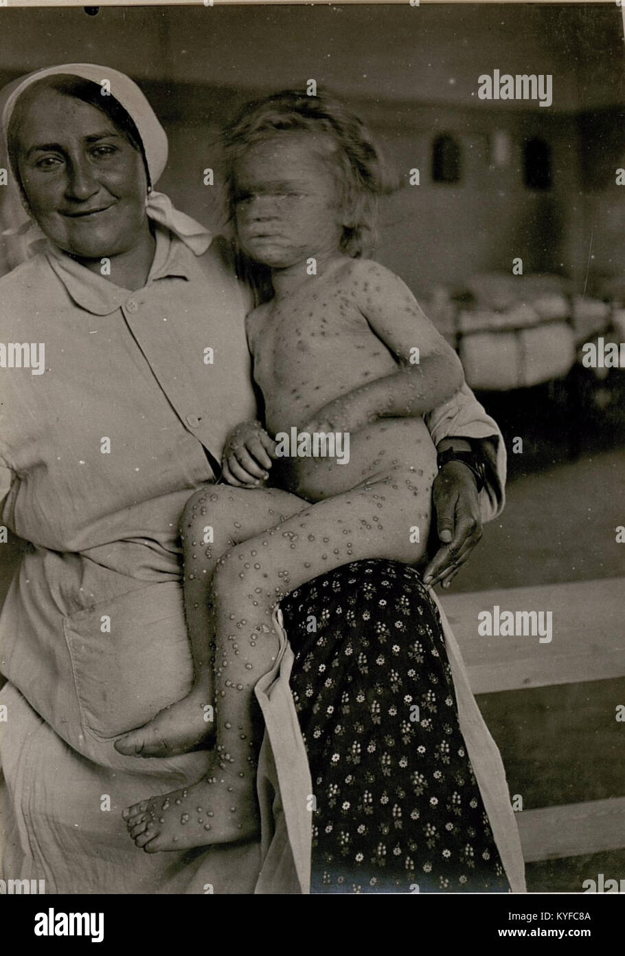 A historical image documenting the case of smallpox in a girl, taken in ...