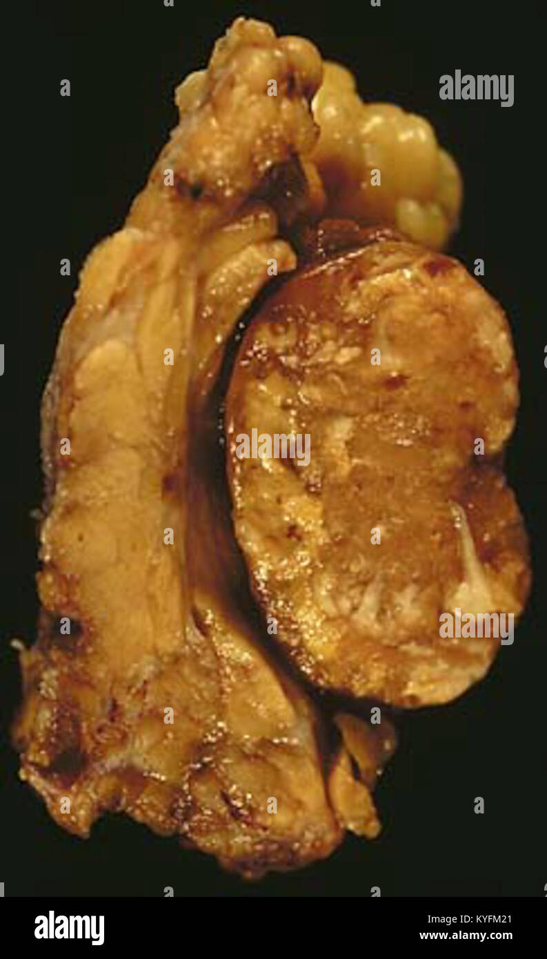 Warthin's tumor is a benign salivary gland tumor of the parotid, named ...