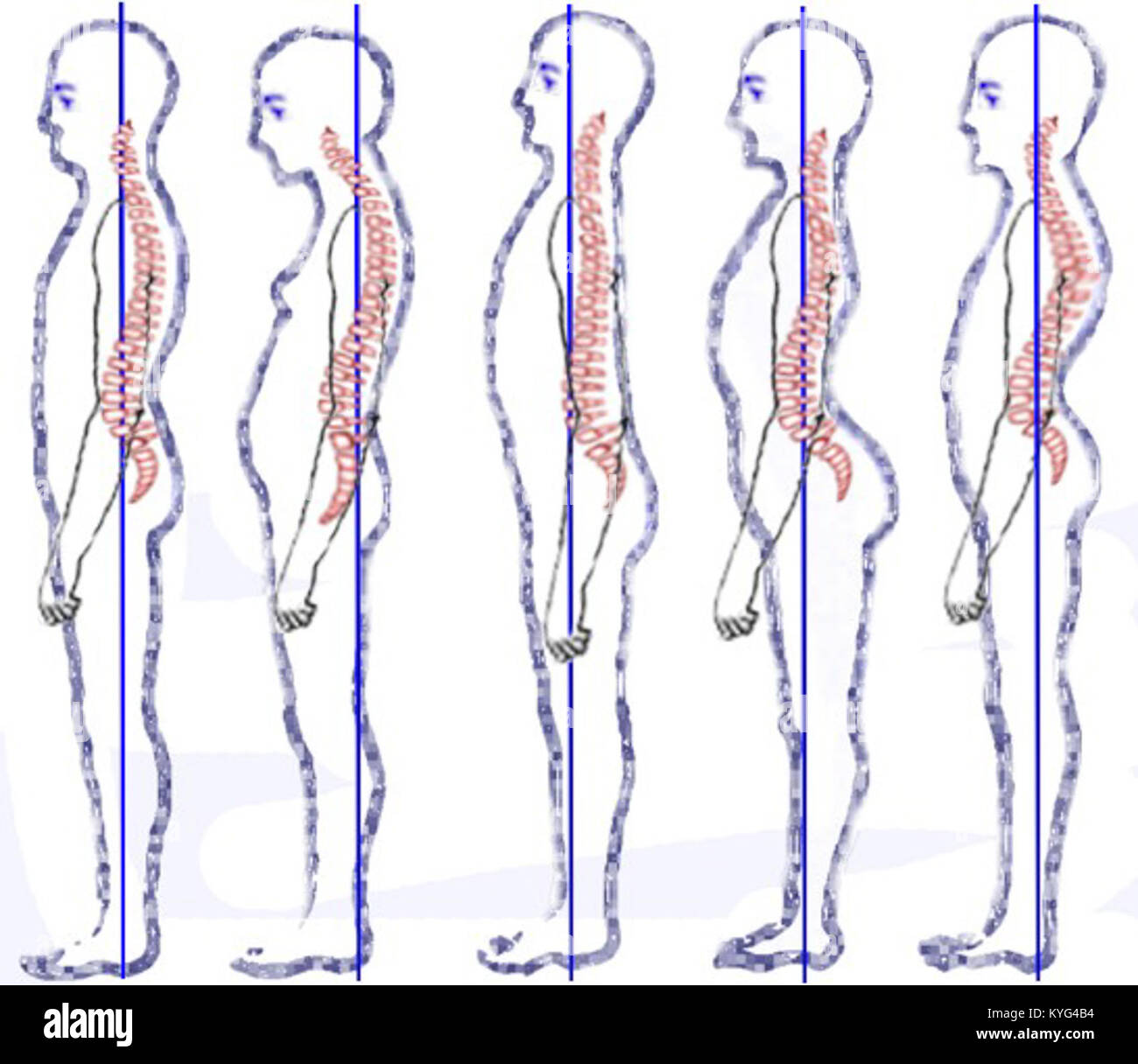 Illustration showing types of human vertebral column posture, including ...