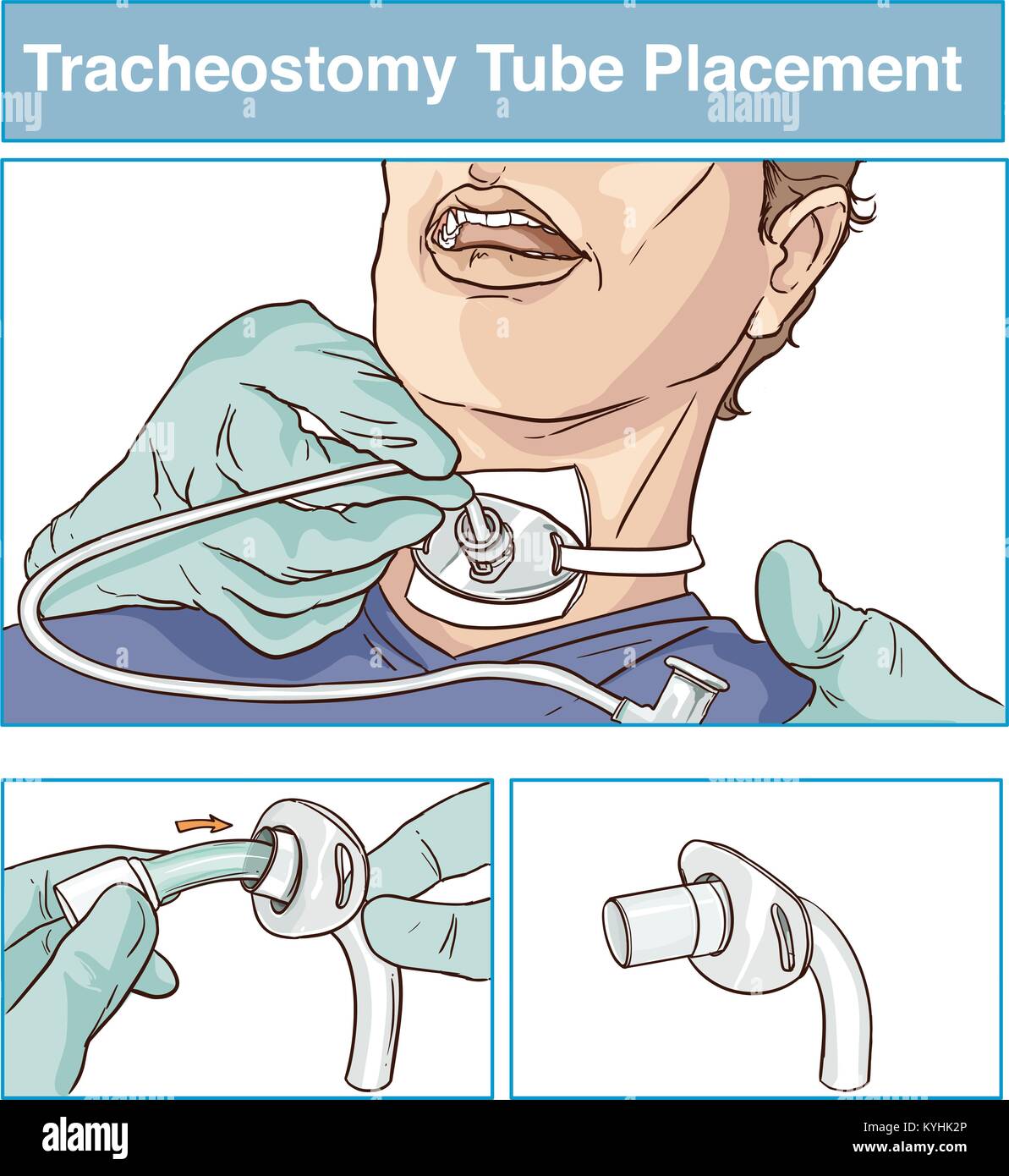 vector illustration of a Chronic kidney disease Stock Vector Image ...