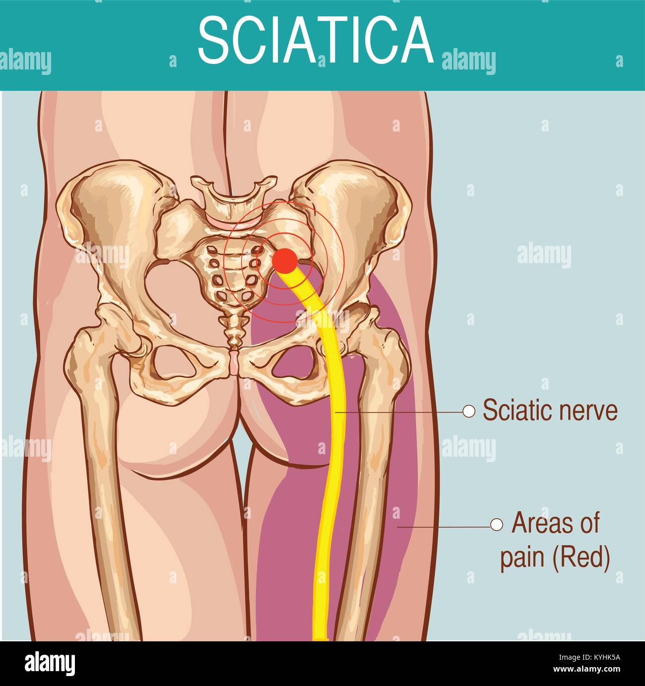 medical illustration of symptoms of sciatica Stock Vector Image & Art - Alamy