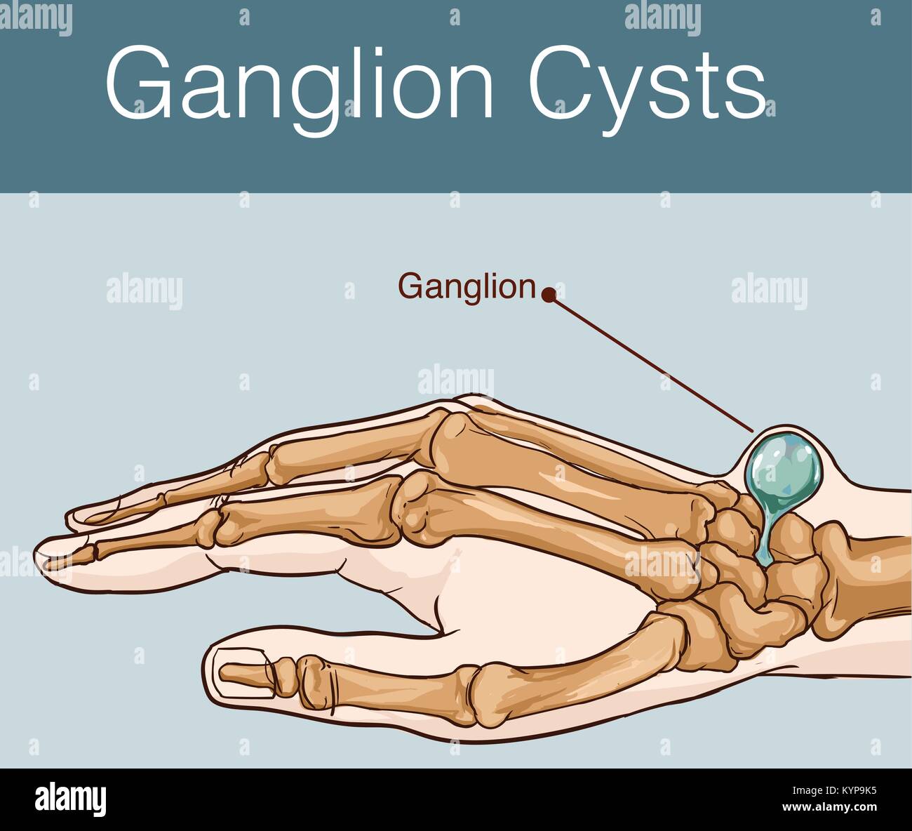Ganglion cyst black and white vector drawing Stock Vector Image & Art ...