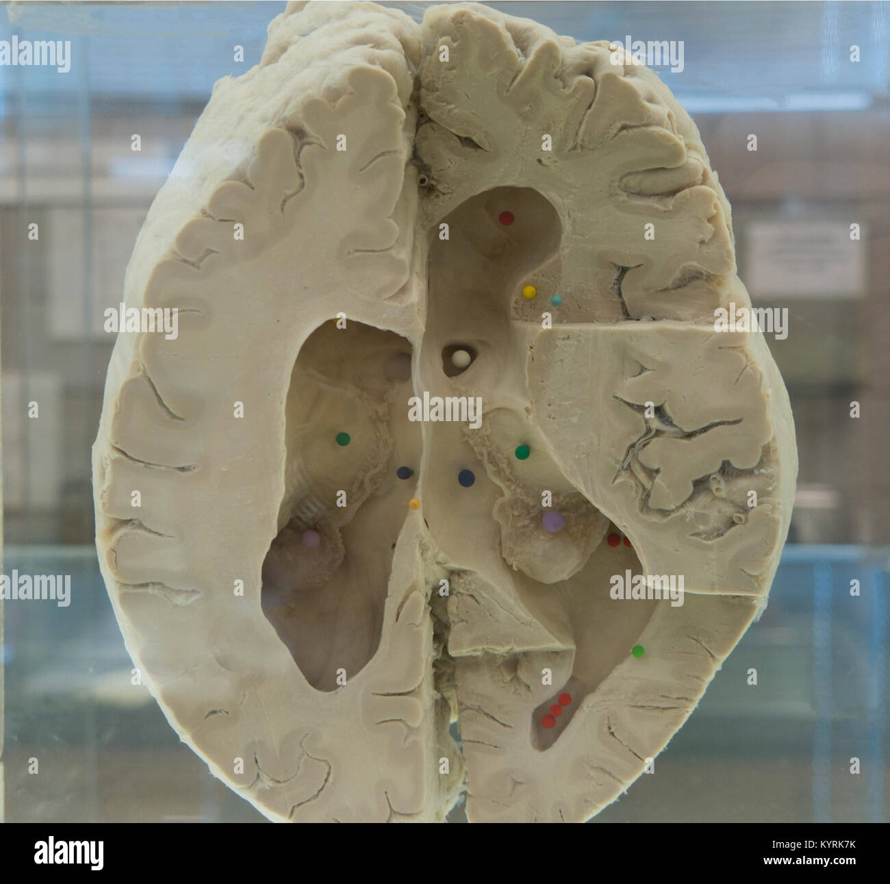 Due to blockage in the cerebral aqueduct hi-res stock photography and ...