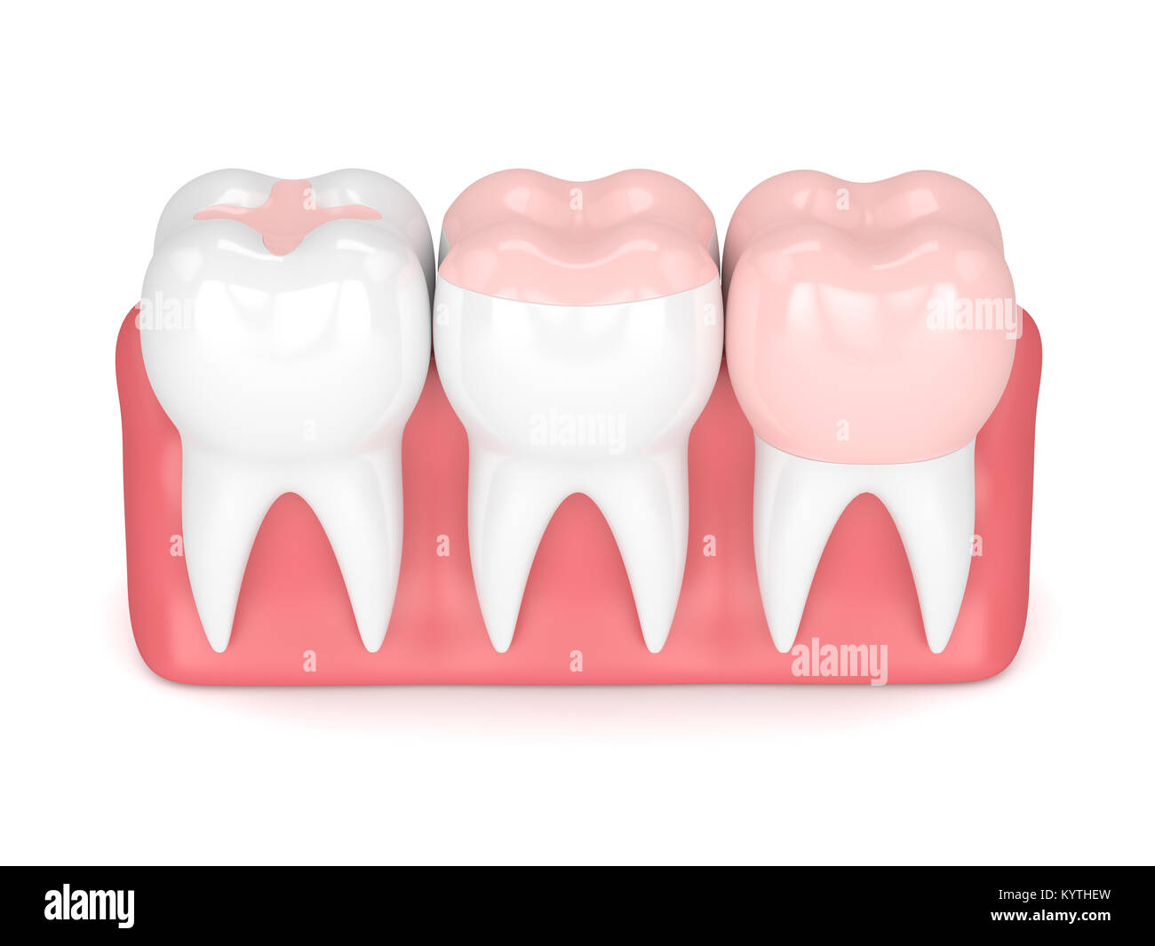 3d render of teeth with inlay, onlay and crown filling over white ...