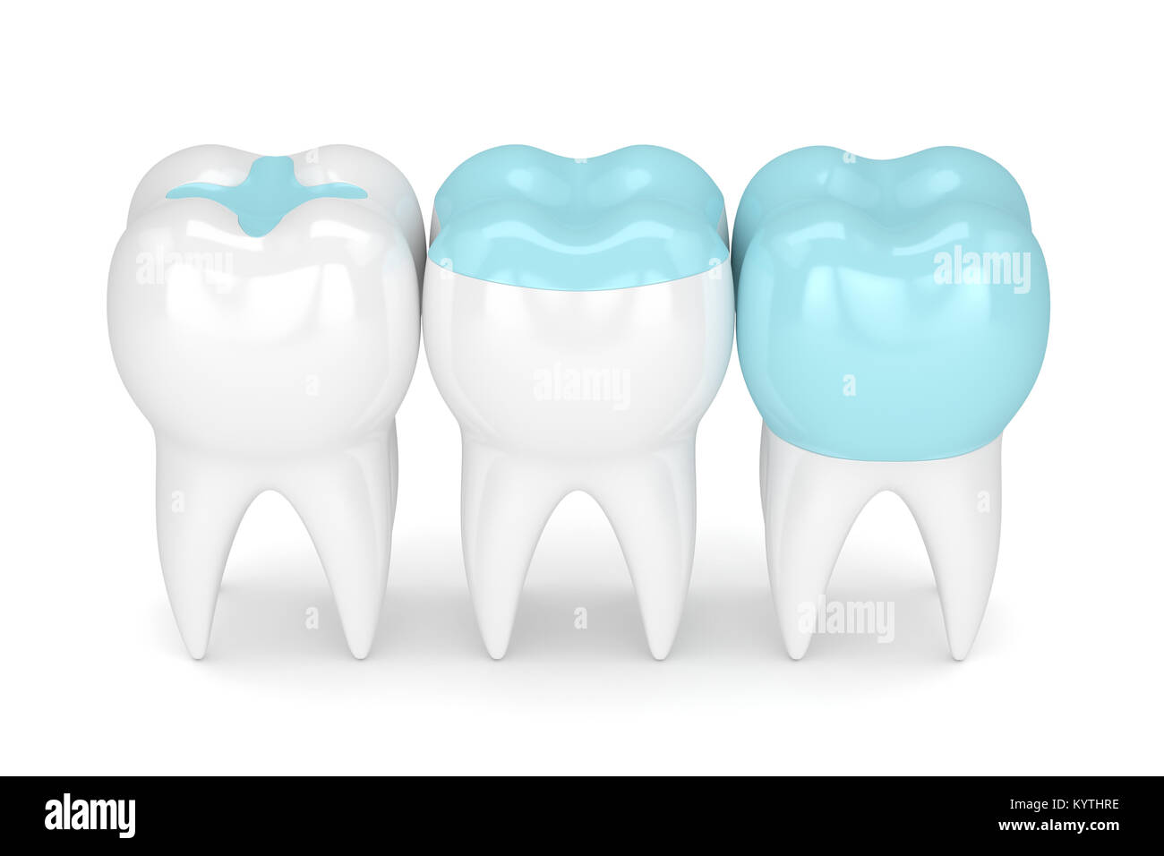 3d render of teeth with inlay, onlay and crown filling over white ...
