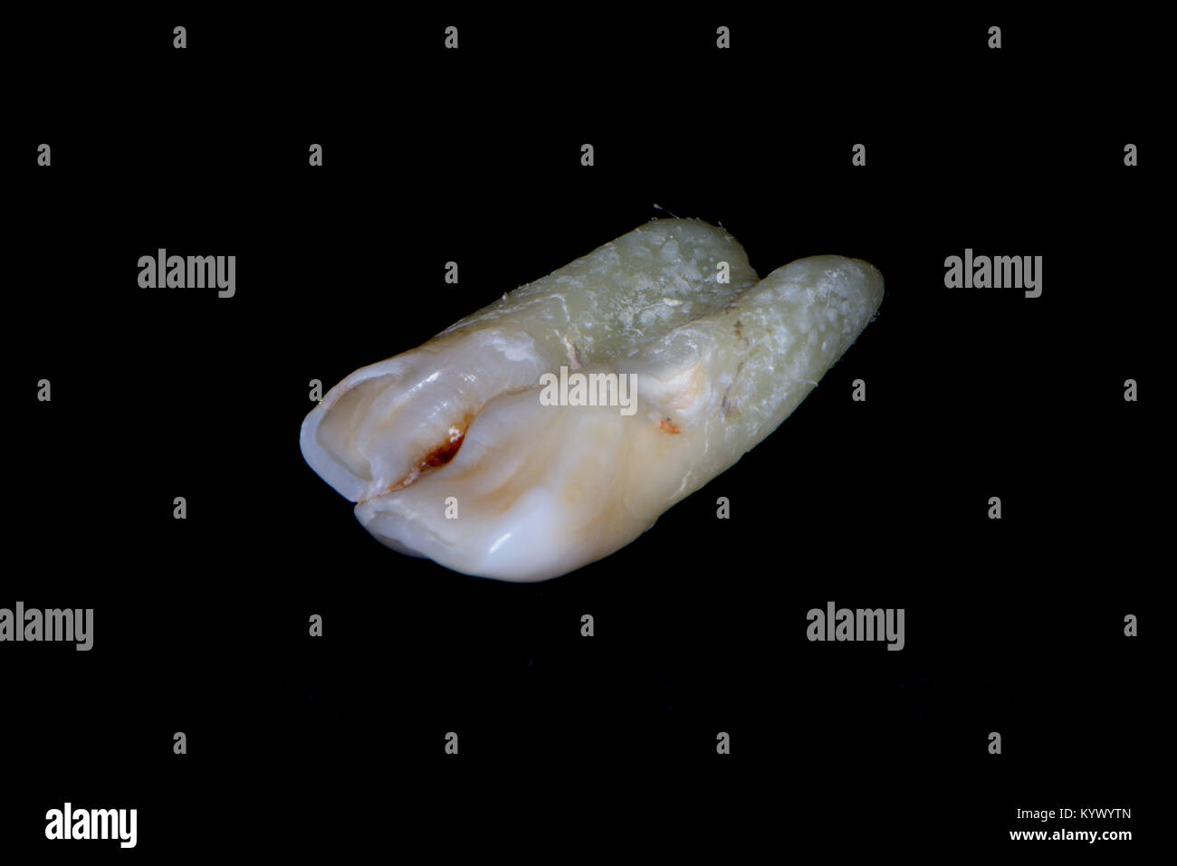 tooth fusion or gemination or concrescence Stock Photo - Alamy