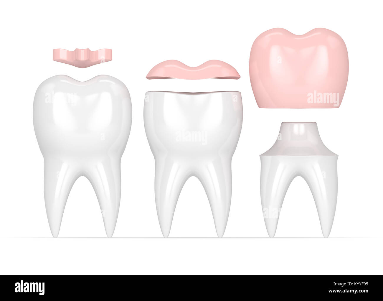 3d render of teeth with inlay, onlay and crown filling over white ...
