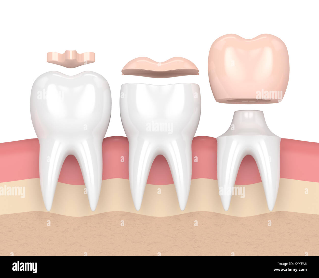 3d render of teeth with inlay, onlay and crown filling in gums Stock ...