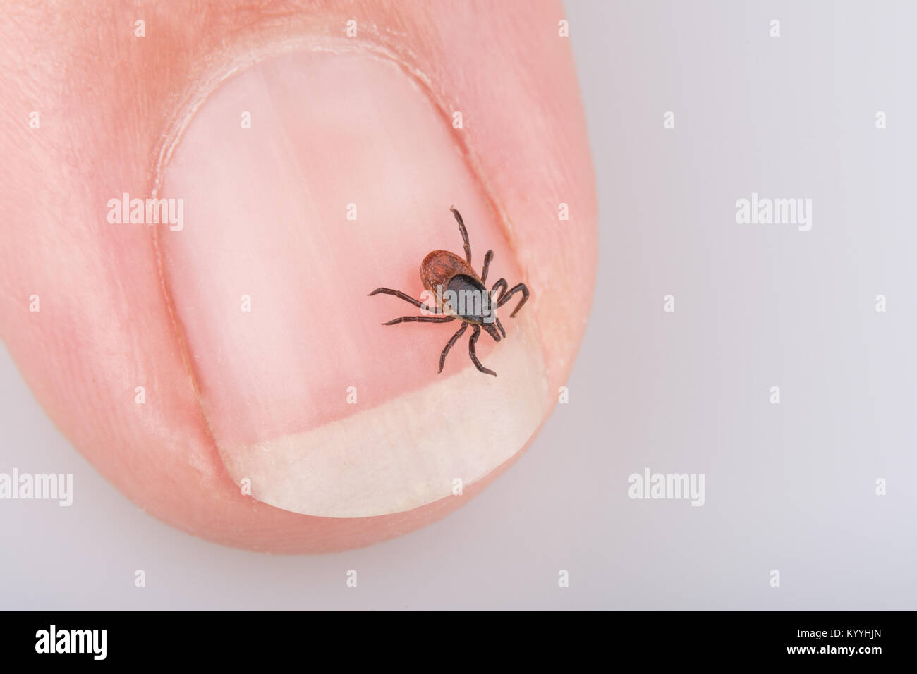 Nail disease hi-res stock photography and images - Alamy