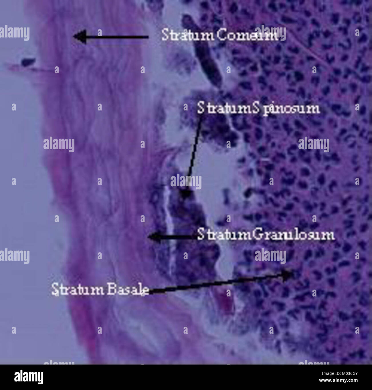 Bullous Impetigo Histology