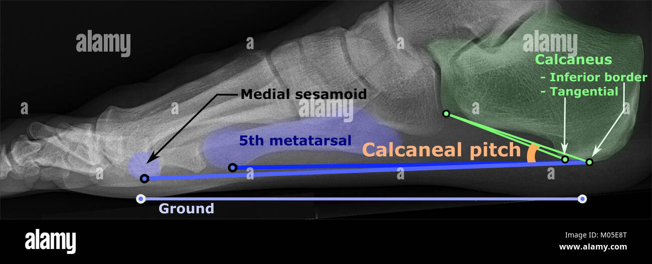 Calcaneal pitch refers to the angle or inclination of the heel bone ...