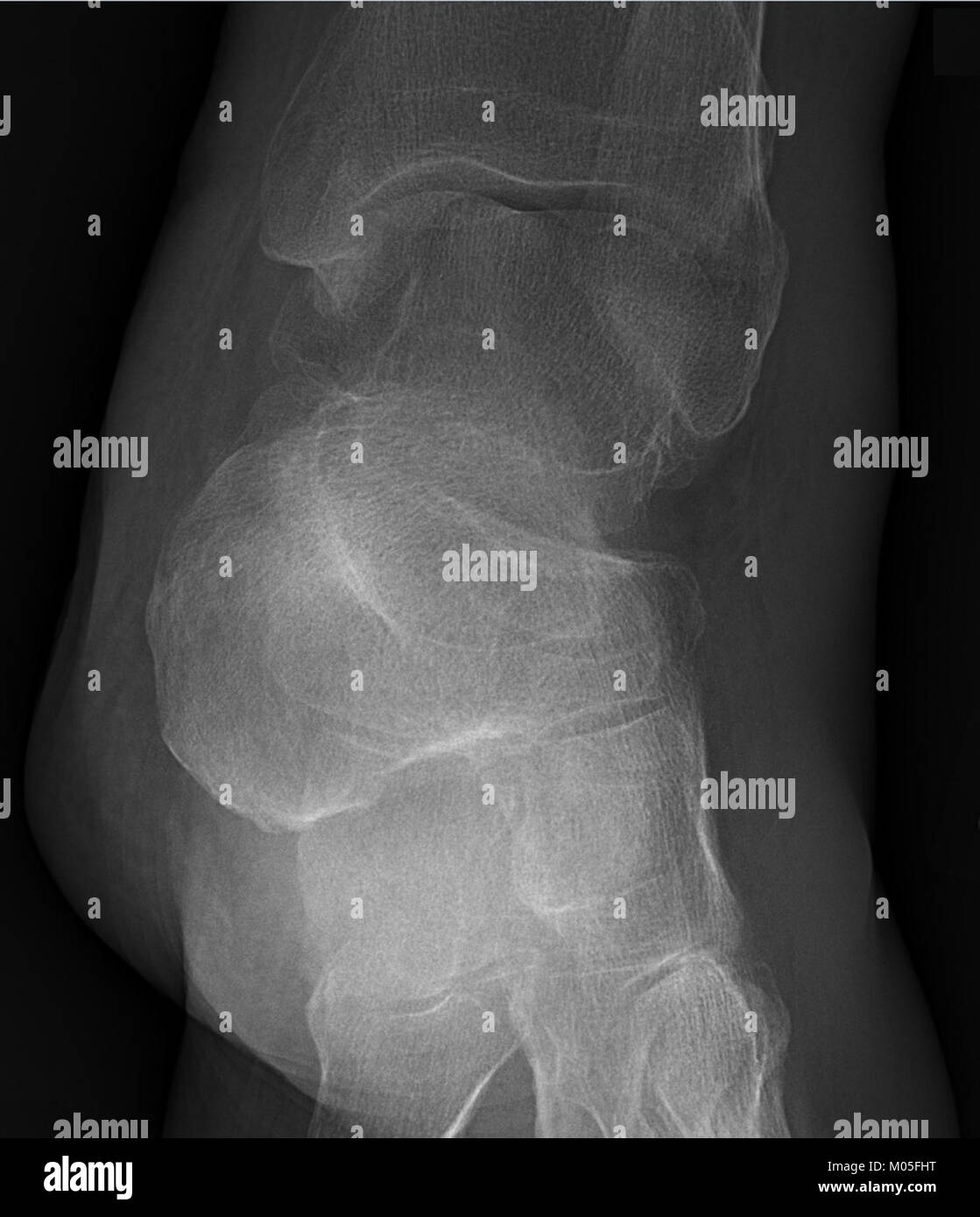 Calcaneal fragment - anteroposterior Stock Photo - Alamy