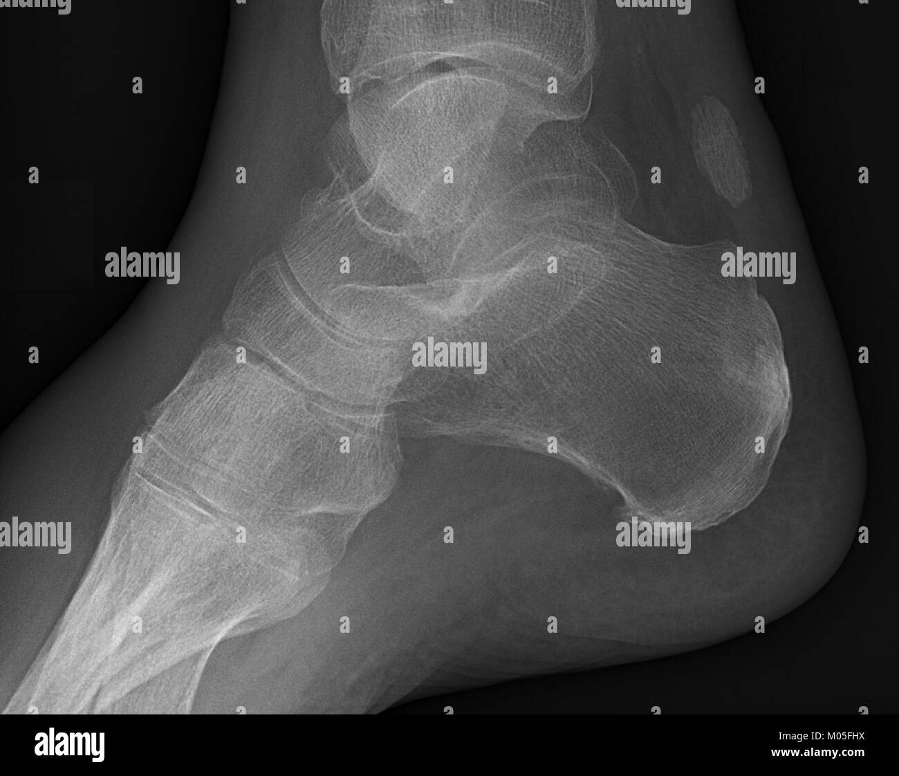 Lateral calcaneal hi-res stock photography and images - Alamy